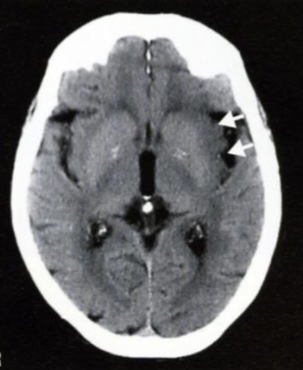 [頭部CT]early CT sign とは何か？原因から画像を考えよう！ - 放射線技師一年目の教科書